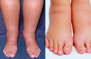 O que é Edema Periférico? Conheça as causas, tratamento e cuidados ...